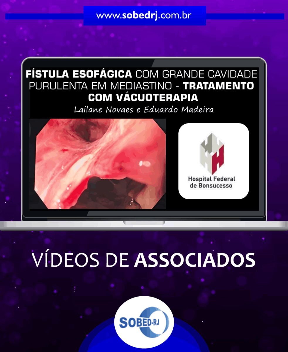 Fístula esofágica com grande cavidade purulenta em mediastino ...