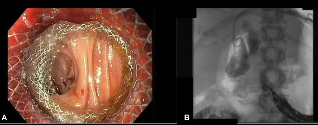 VÍDEO: EUS-guided enteroenterostomy to facilitate peroral altered ...