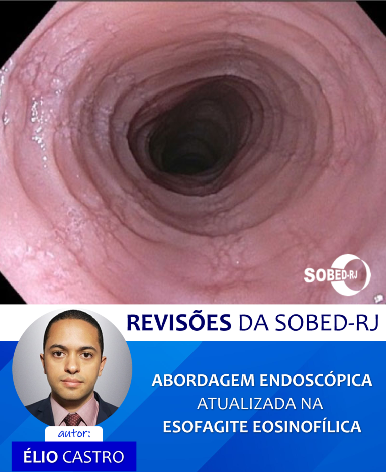 Abordagem Endoscópica Atualizada na Esofagite Eosinofílica | SOBED-RJ