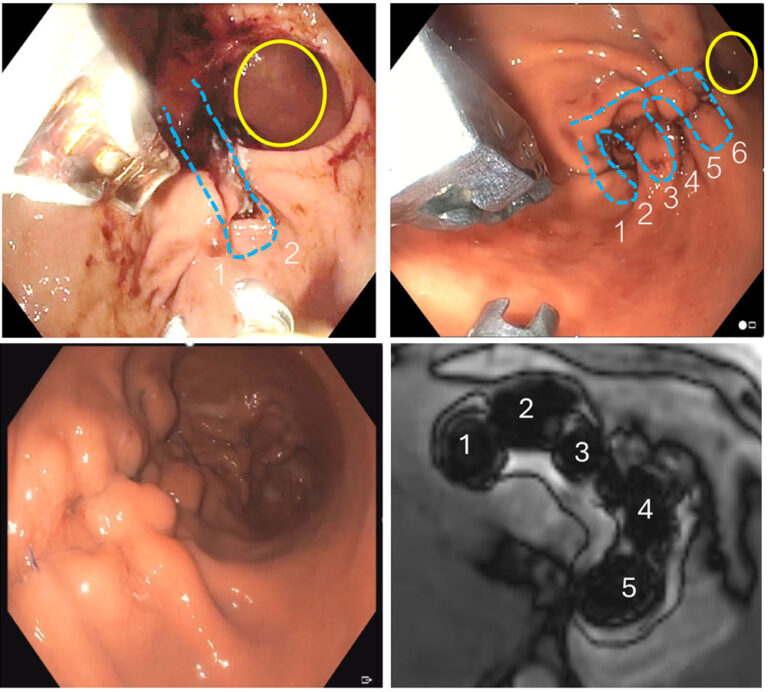 VÍDEO: Interlocking endoscopic sleeve gastroplasty with next-generation ...